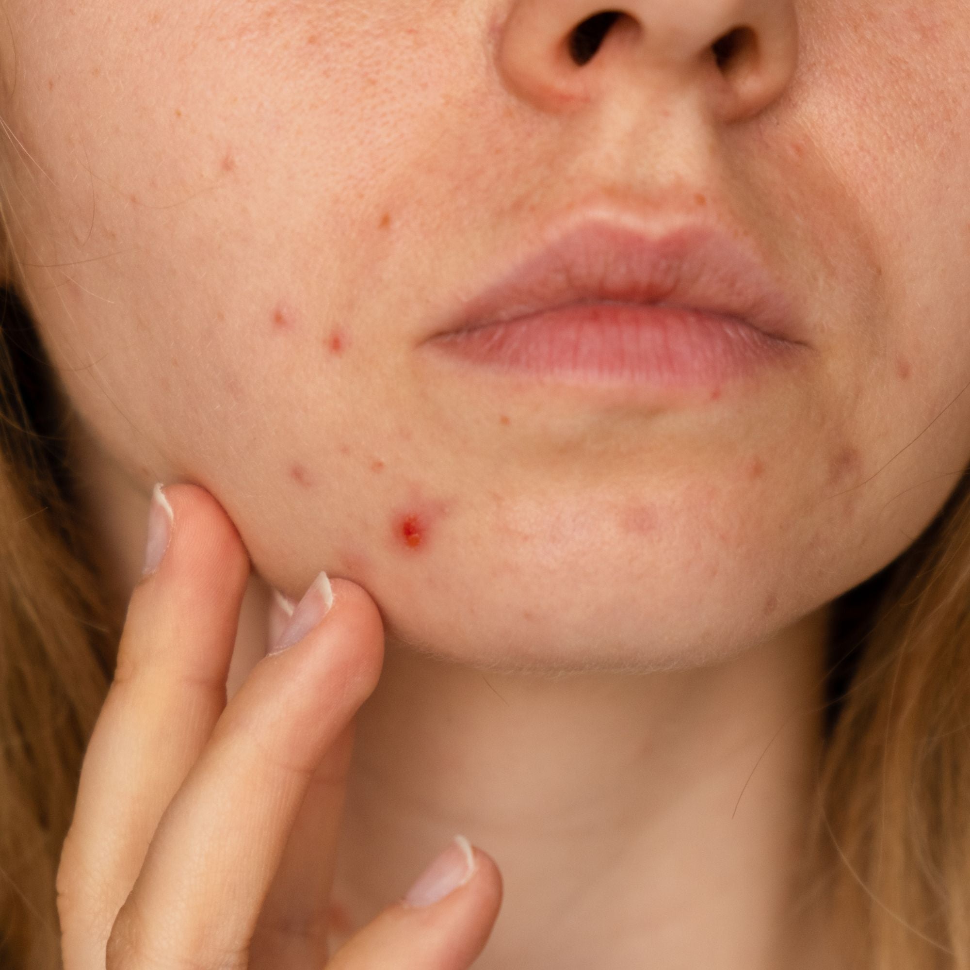 Dealing with Infected Pimples: Tips & Treatment – MulSecrets