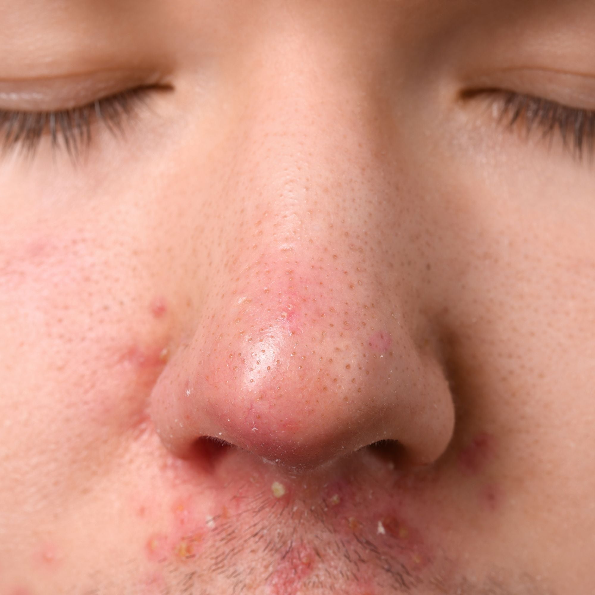 Understanding Comedonal Acne: Causes & Treatment Options – MulSecrets