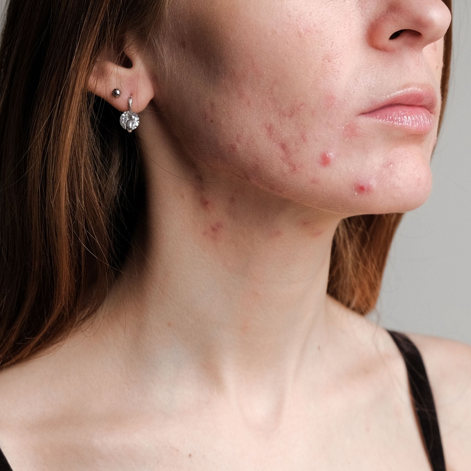 Effective Ways to Treat Facial Acne from Dandruff | Skincare Tips ...