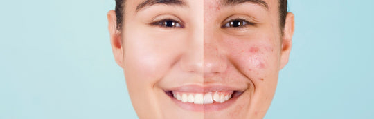 5 Different Types of Skin Blemishes on The Face And Its Treatments ...