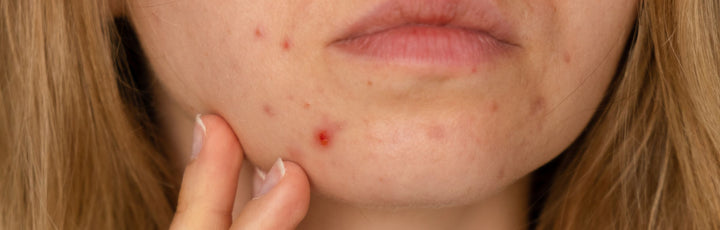 Dealing with Infected Pimples: Tips & Treatment – MulSecrets
