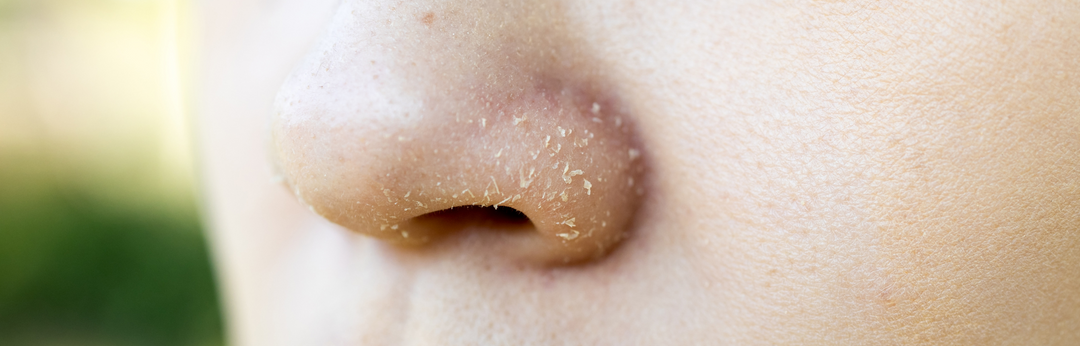 Reasons of Dry Skin Around Nose & How To Treat It? – MulSecrets