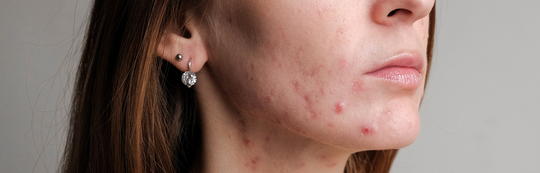 Effective Ways to Treat Facial Acne from Dandruff | Skincare Tips ...